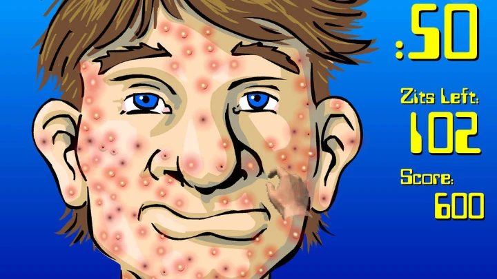 Acne Be Gone - the Game